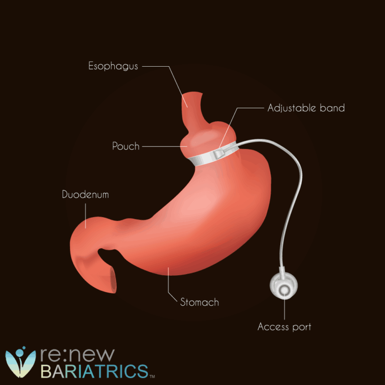 Bariatric Surgery Success Rates - Gastric Sleeve, Gastric Bypass ...