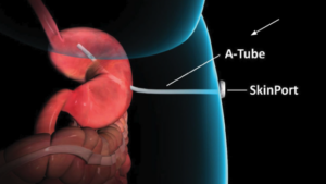 vBlock Theray Bariatric Procedure Overview - Renew Bariatrics