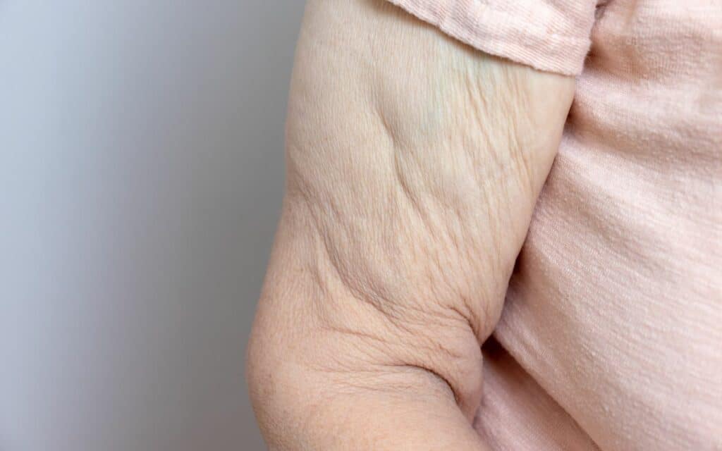 Loose Skin after Gastric Sleeve Surgery - Renew Bariatrics