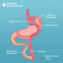 Renew Bariatrics® - Weight Loss Surgery in Mexico