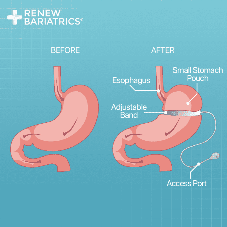 Gastric Banding: Laparoscopic Adjustable Gastric Band Surgery | Renew ...