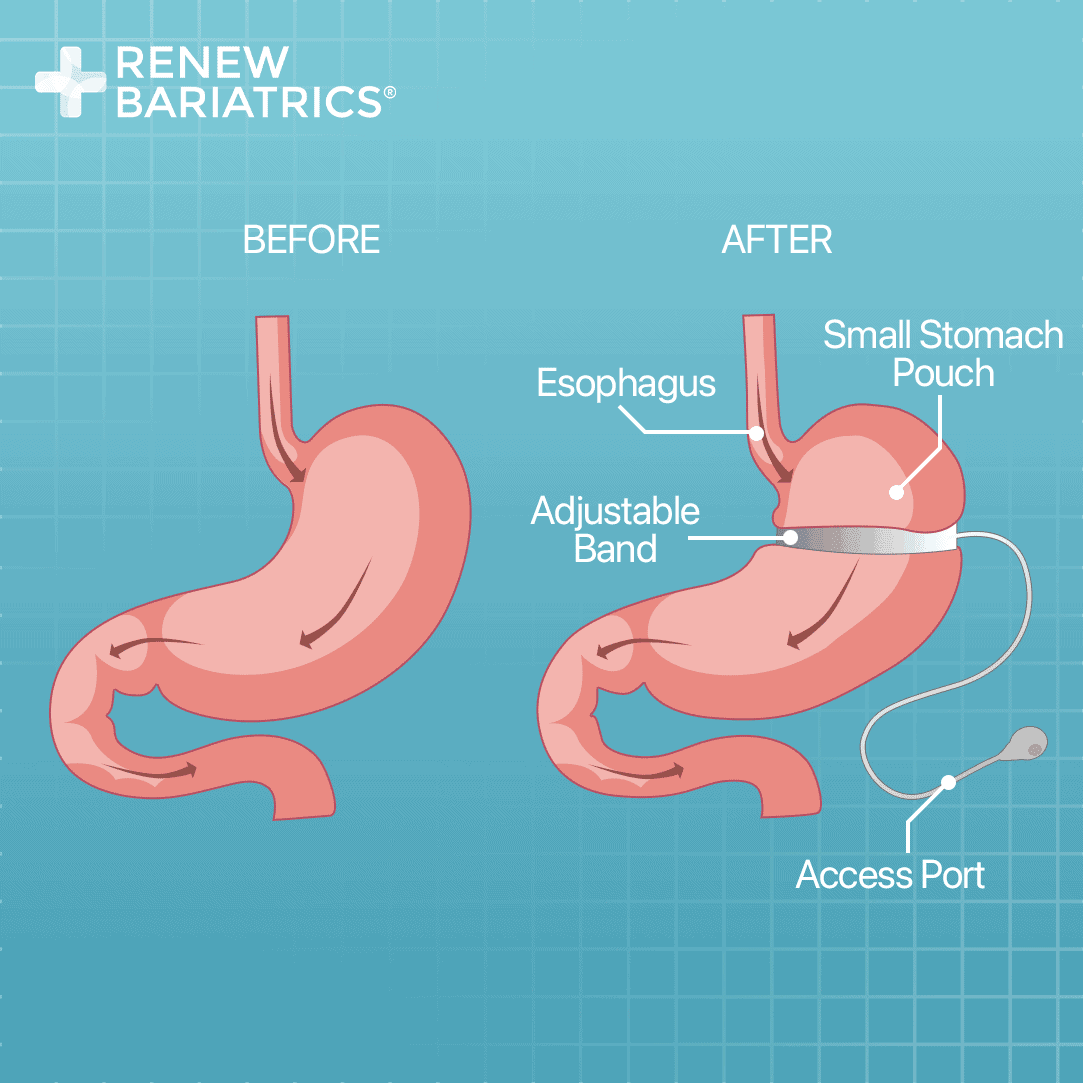 Lap-Band Failure, Removal - Renew Bariatrics