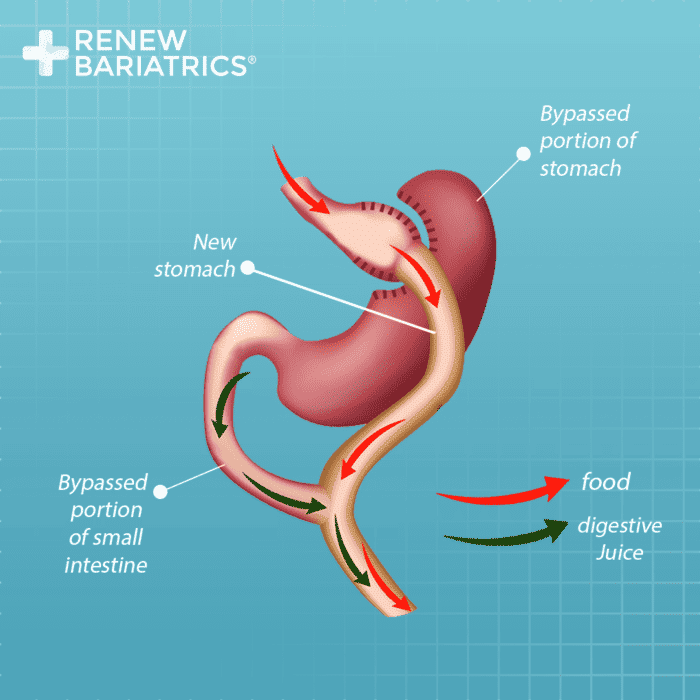 Mini-Gastric Bypass Surgery in Mexico