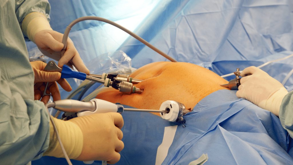 Types of Reversible Bariatric Surgery: Questions and Guides