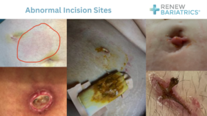 Incision Care after Bariatric Surgery | Photos | Healing & Recovery
