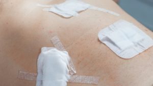Incision Care after Bariatric Surgery | Photos | Healing & Recovery