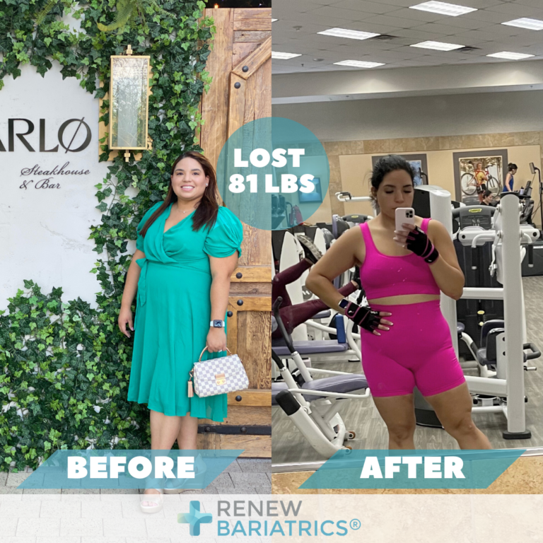Bariatric Surgery Before and After Photos