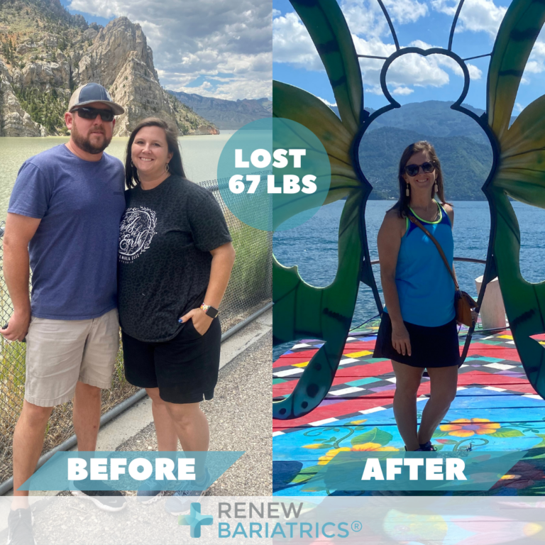 Bariatric Surgery Before and After Photos