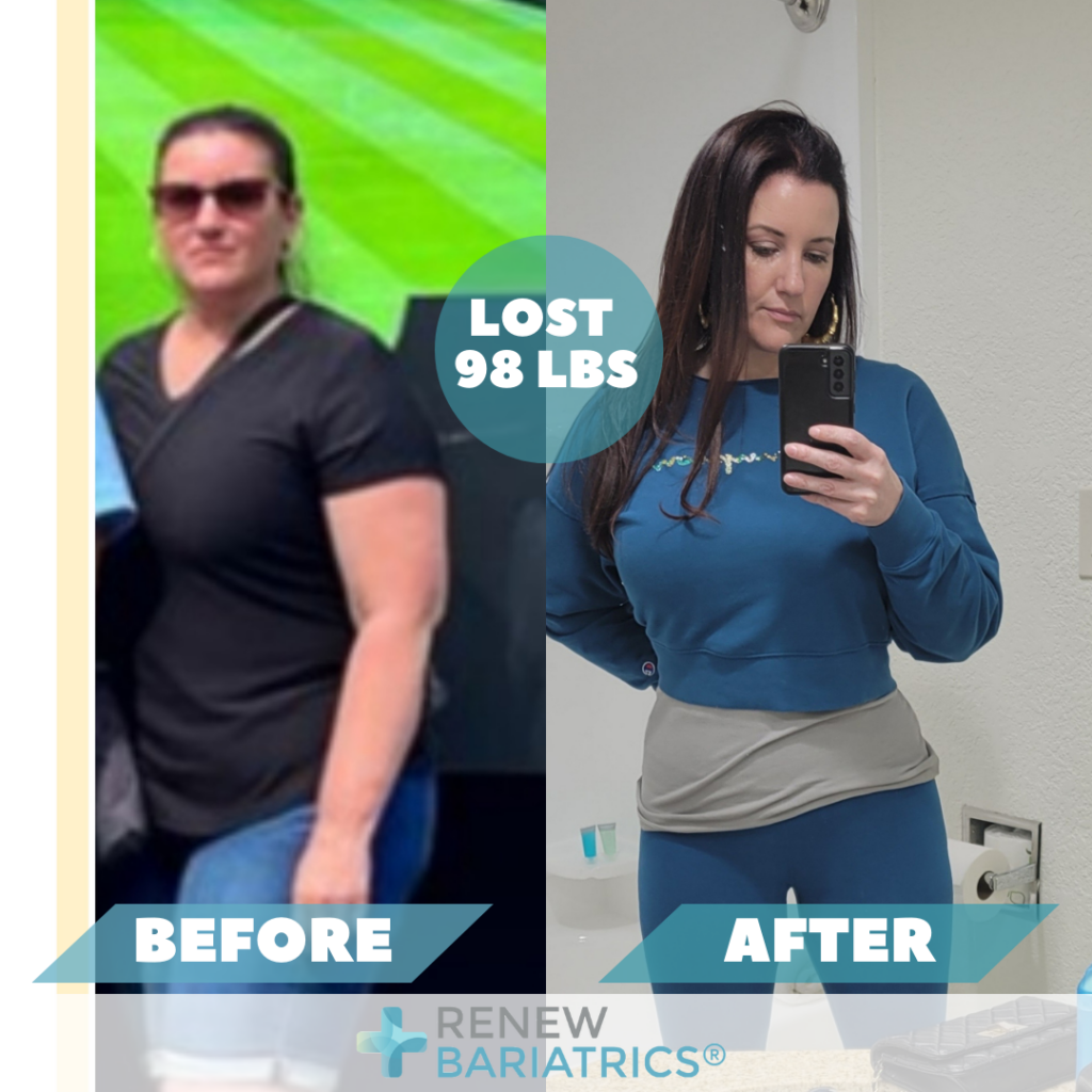 Gastric Sleeve Revision in Tijuana, Mexico | Renew Bariatrics