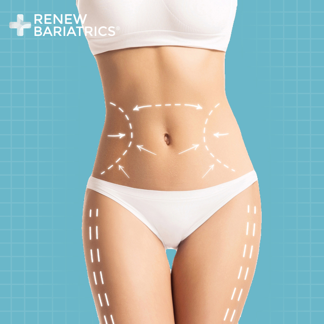 Plastic Surgery in Mexico - Renew Bariatrics