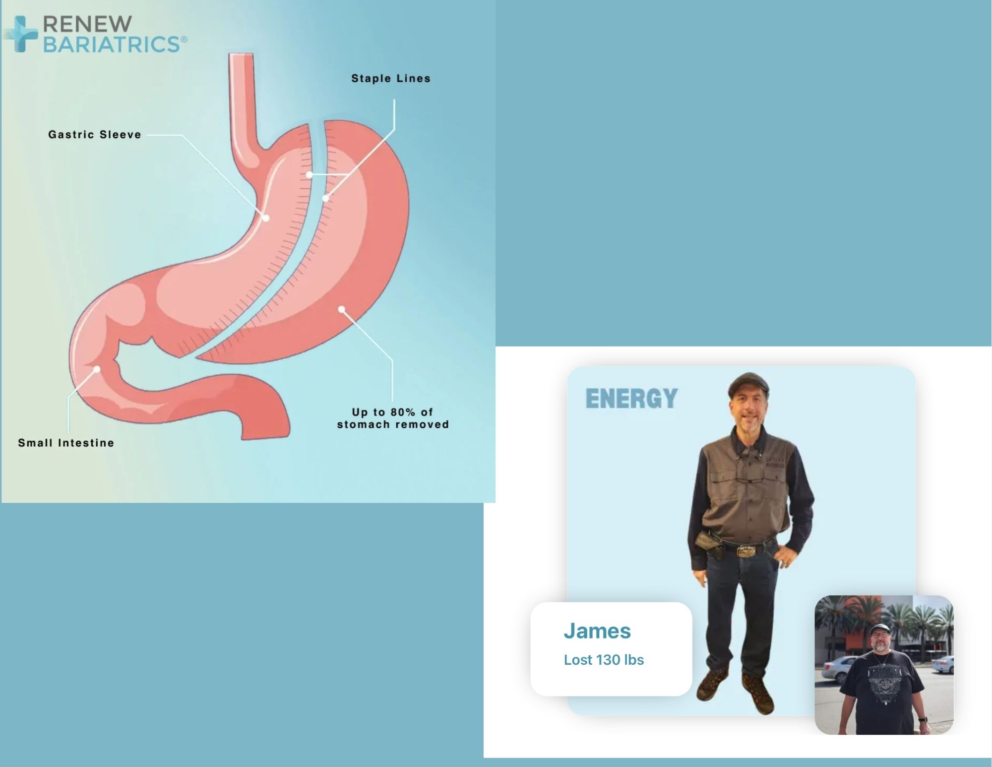 Advances in Minimally Invasive Bariatric Techniques - Renew Bariatrics